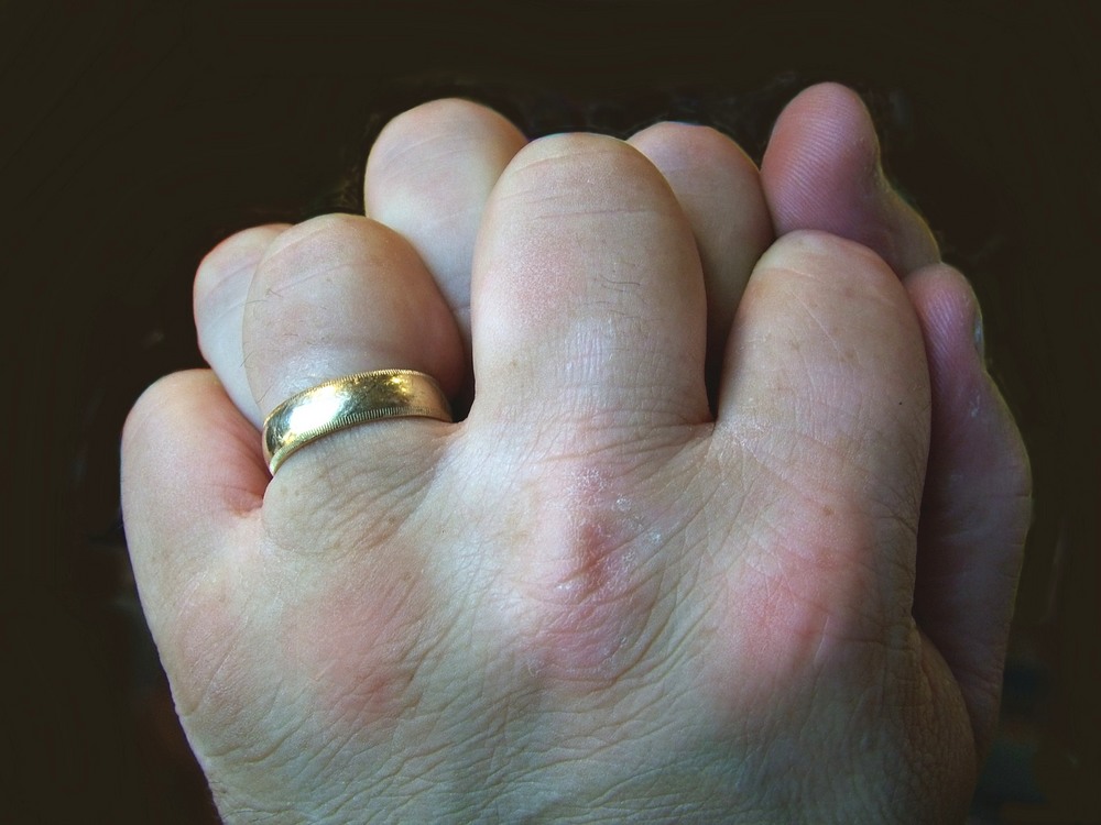 Cracking Your Knuckles Does Not Cause Arthritis Cracking Your Knuckles Does Not Cause Arthritis