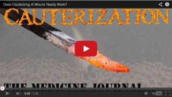 cauterization