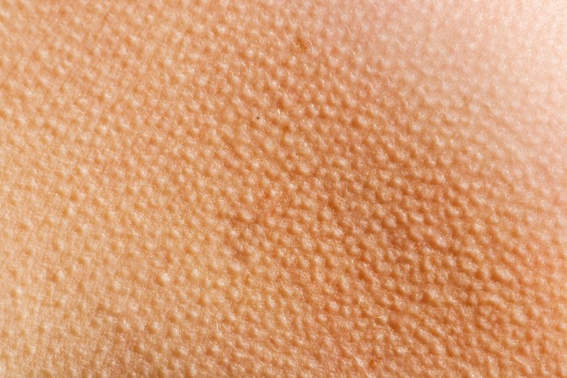 What Are Goose Bumps?