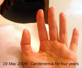 Carotenemia-340x280